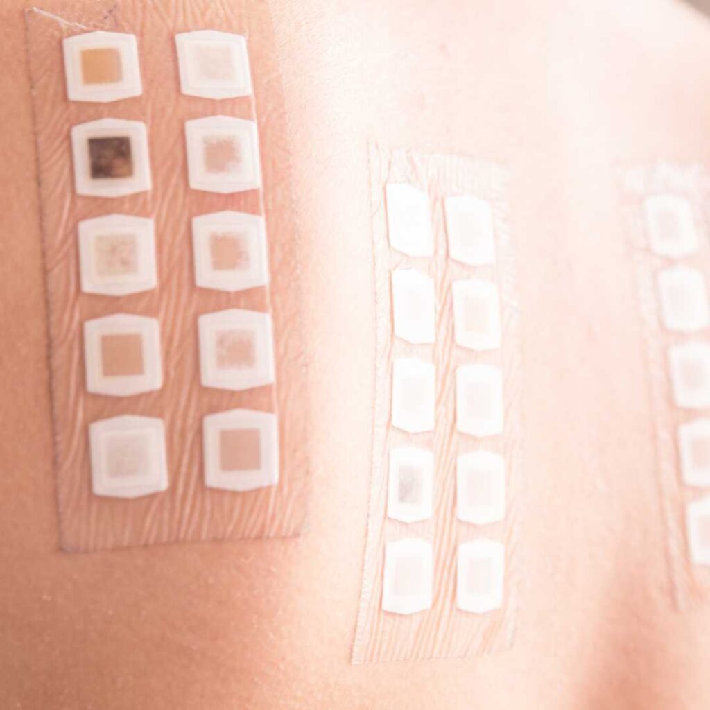 Patch Testing for Allergies - Contact Dermatitis, Eczema, Rashes