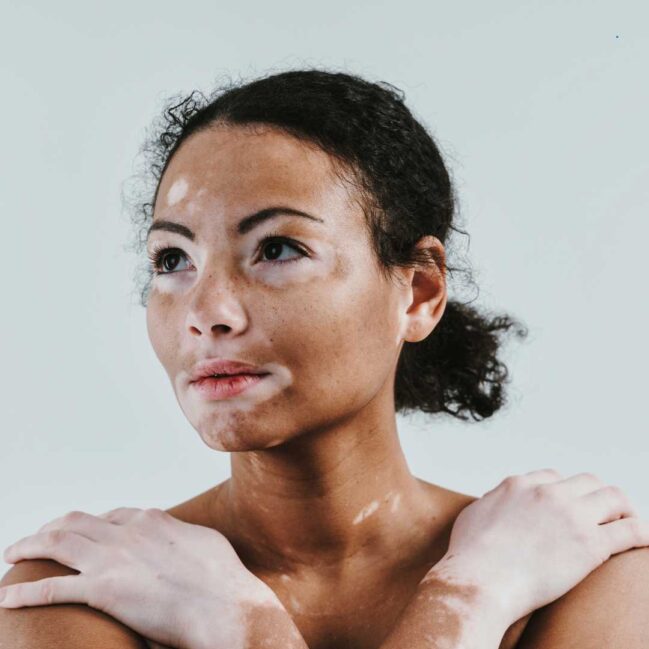 Vitiligo Treatment for Facial Discoloration and White Skin Patches