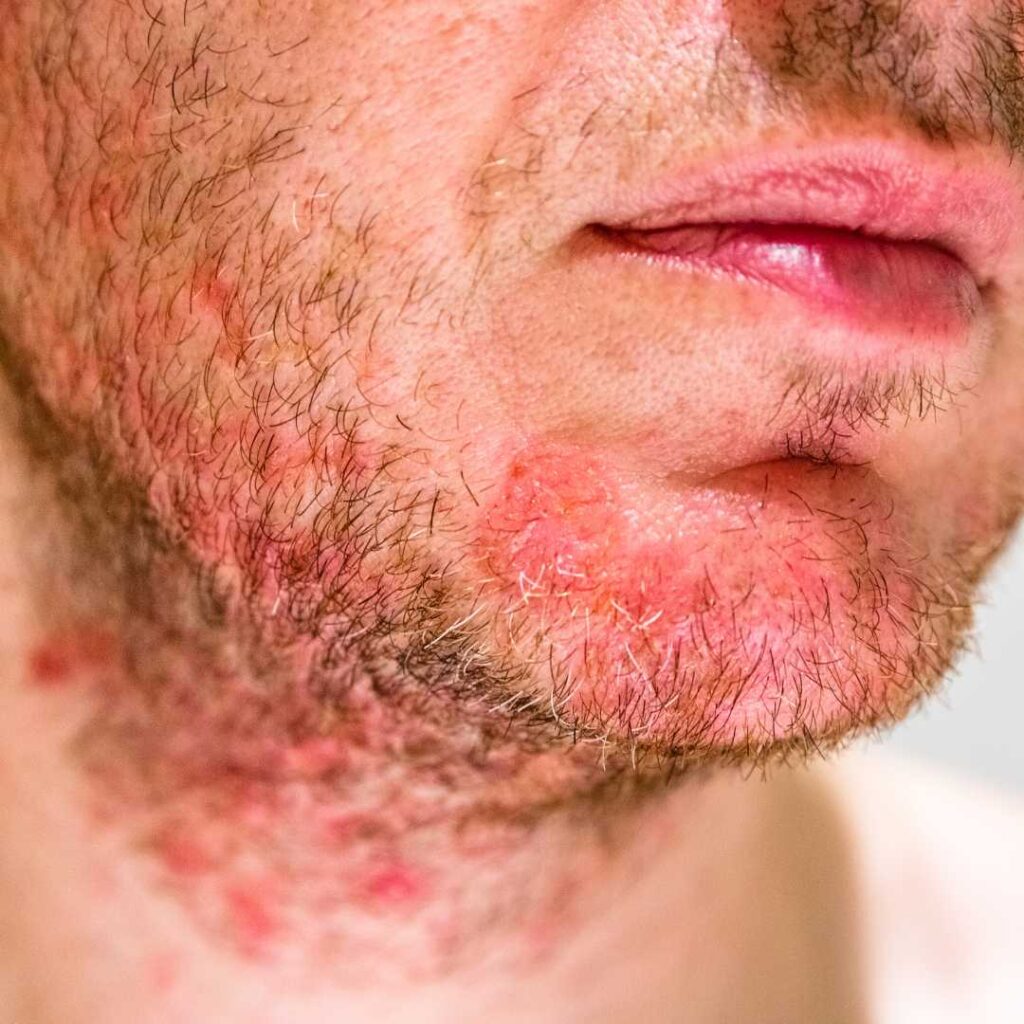 Dermatitis - Causes, Types & Treatments in Abu Dhabi | EDCC